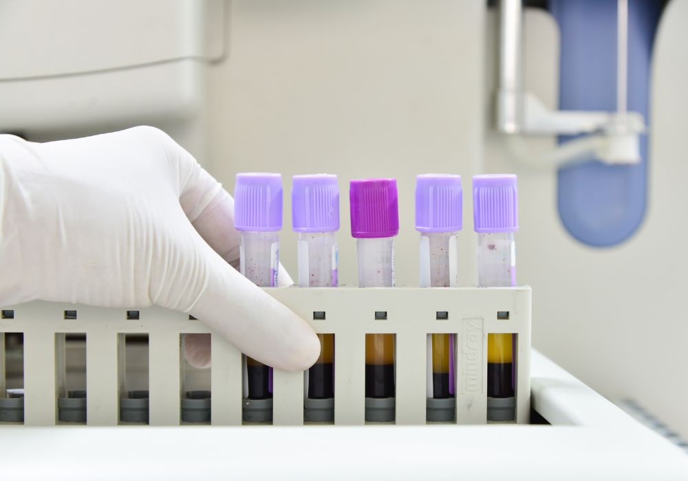 What do the CBC Blood Test results mean? Understanding the Complete ...