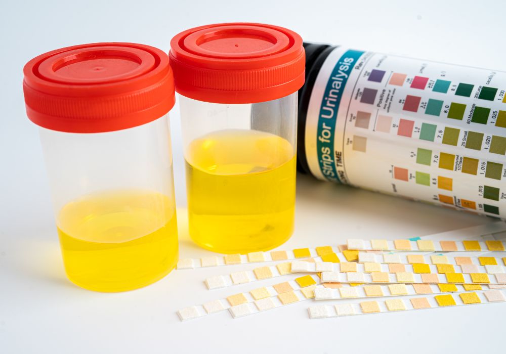Demystifying Urinalysis: Understanding the Test and Results | Mezator