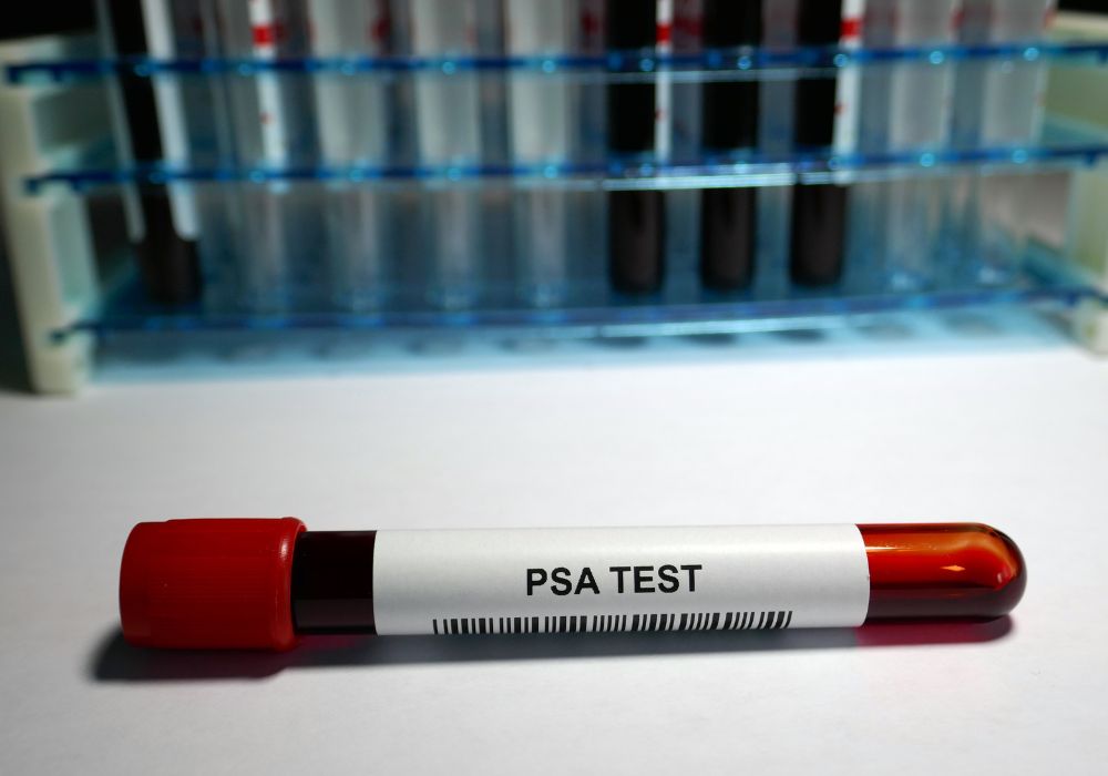 Prostate-Specific Antigen (PSA) Testing: A Key to Prostate Health | Mezator